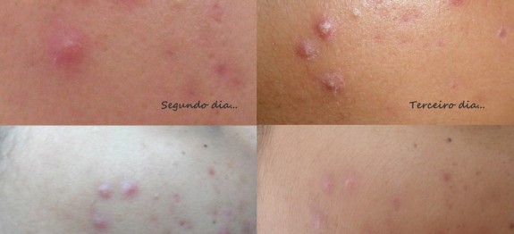 Secando espinhas com pasta de dente - Veja a Receita: