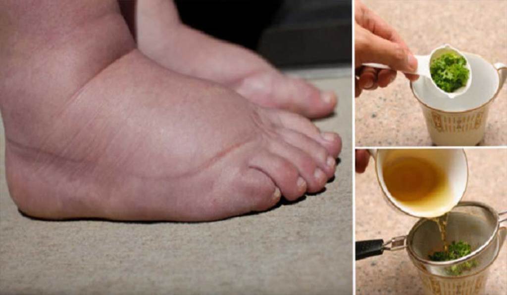 Você nunca mais terá problemas com pernas e pés inchados com esse ...