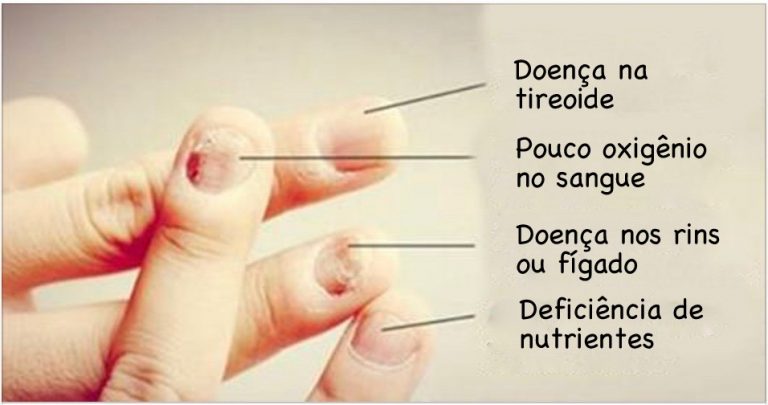 10 SINAIS NAS UNHAS QUE PODEM INDICAR PROBLEMAS GRAVES DE SAÚDE! - Veja ...
